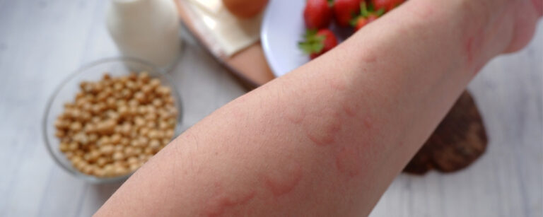 Papular Urticaria - Complete Guide and Are Hives Contagious?