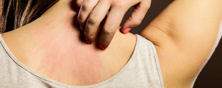 Stress Rash - How Stressful Is It?