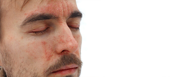 Discoid Lupus Rash: Symptoms, Causes, and Treatment