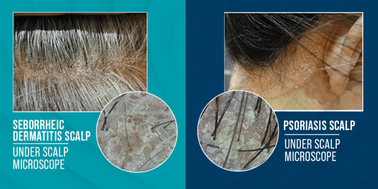 Seborrheic Dermatitis vs Psoriasis - The Difference