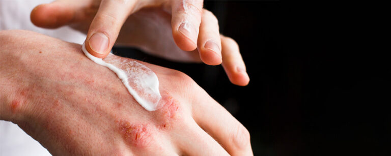 Is Eczema An Autoimmune Disease Or Something Else?