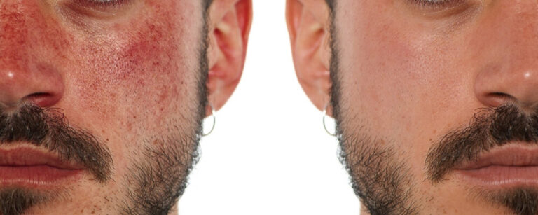 Phymatous Rosacea: Symptoms, Treatments and More