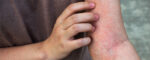 Blanching Rash: Causes and Treatments in Adults and Children