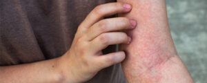 Blanching Rash: Causes and Treatments in Adults and Children