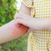 Flexural eczema: Symptoms, Causes and Treatments