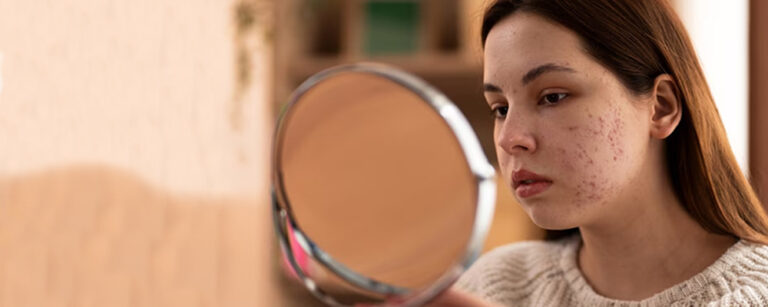 Psoriasiform Dermatitis: Causes, Symptoms, and Treatment