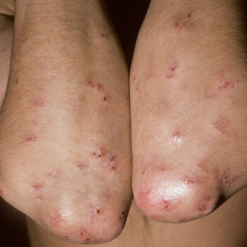 Dermatitis Herpetiformis vs Eczema: Learn the Difference?