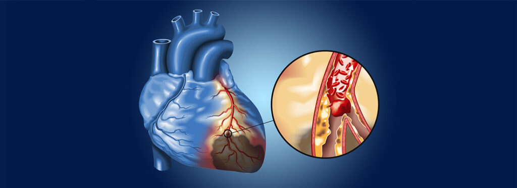 What to Know About a Coronary Thrombosis