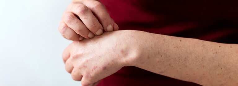 Erythematous vs. Non Pruritic Erythematous Rash: Key Differences