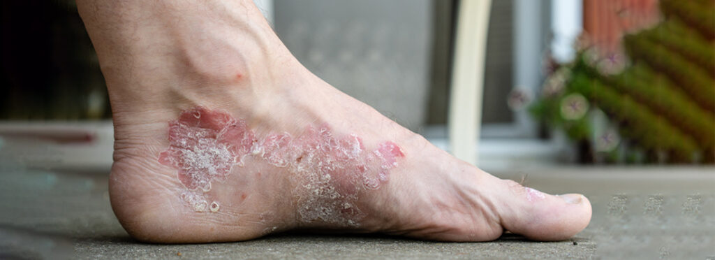 Psoriasis on Feet: Symptoms, Causes, Pictures, and Treatment