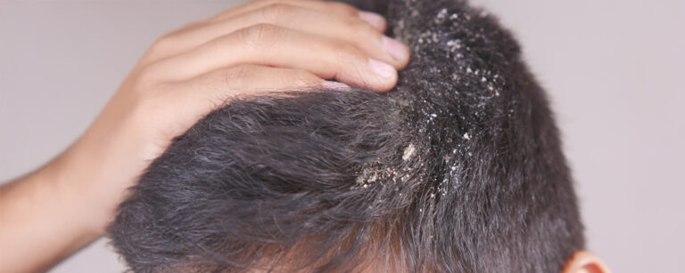 Scalp Psoriasis vs. Dandruff: Spot the Signs & Take Action