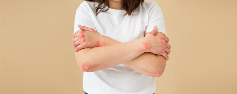 Weeping Eczema: Is Your Skin Telling You Something Serious?