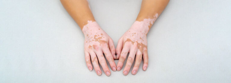 Leucoderma vs Vitiligo: Key Differences, Symptoms, and Treatment